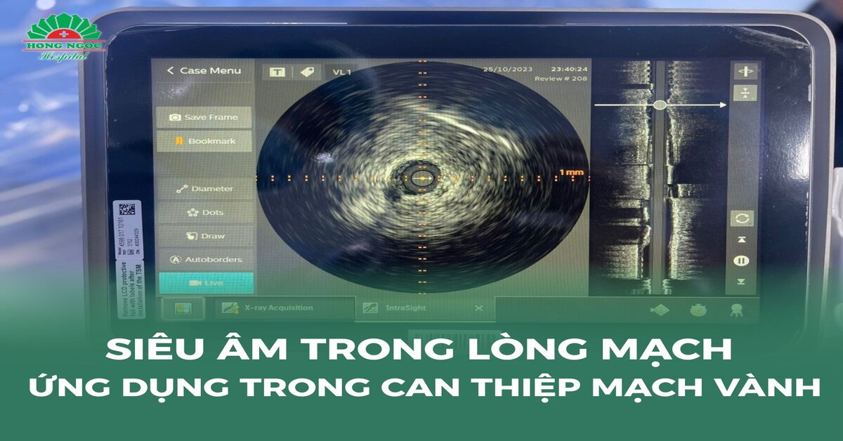 Siêu âm trong lòng mạch - Ứng dụng trong can thiệp mạch vành
